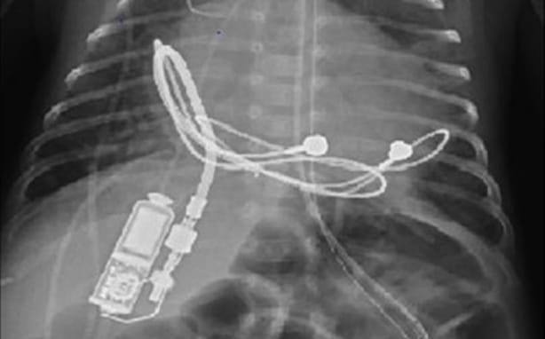 Children's Hospital Installs Smallest Pacemaker in Premature Newborn
